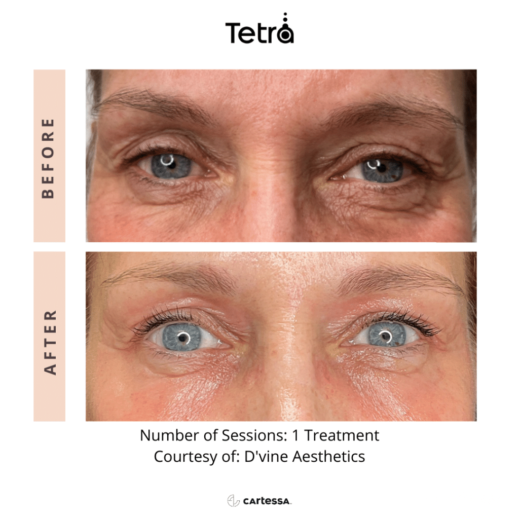 Co2 CoolPeel Laser — glowlaserandbeauty.com